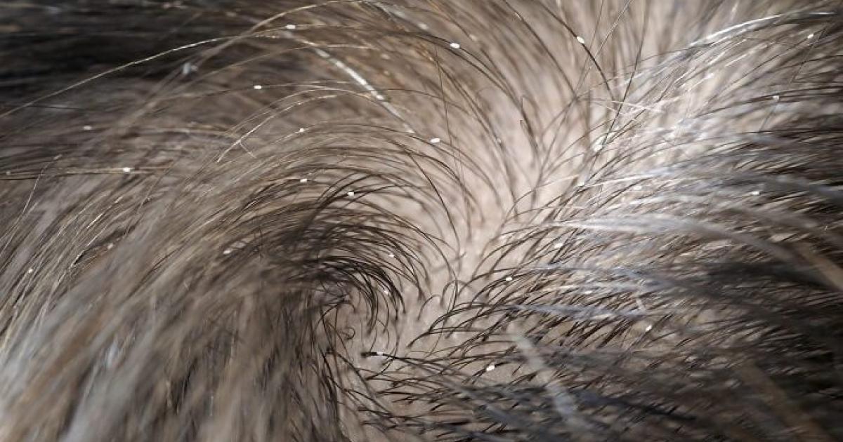 Portal T5 | Tem piolho e lendia? Saiba como tratar e eliminar o…